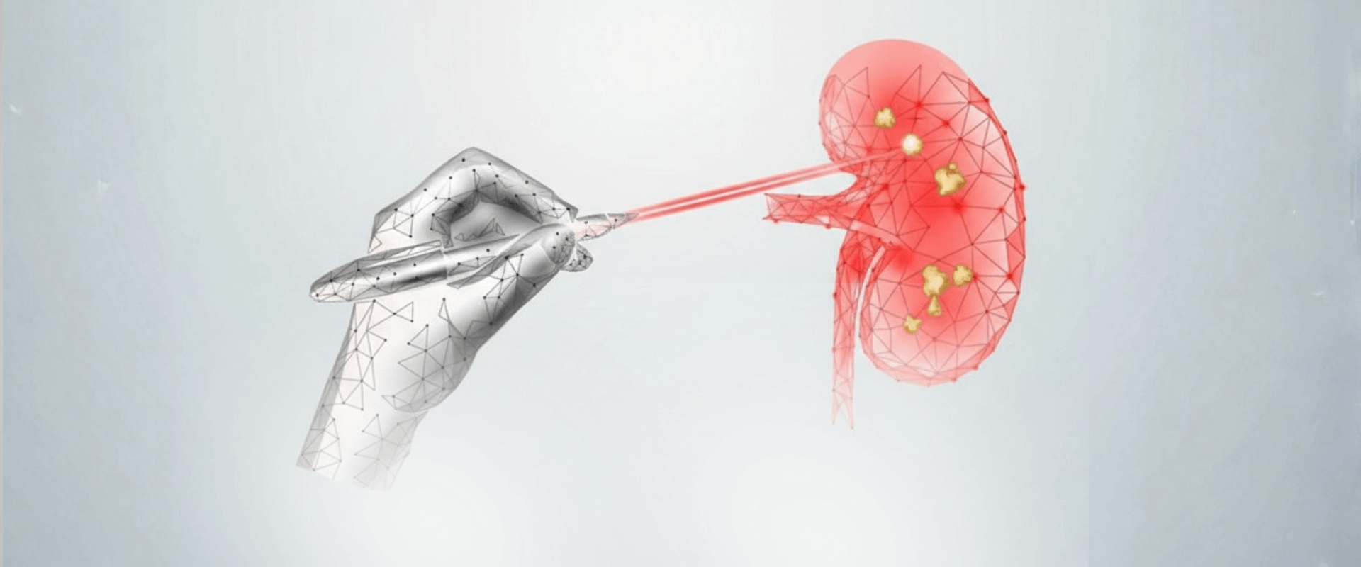 Laser Treatment for Kidney Stones in Dubai | Dr Haluk